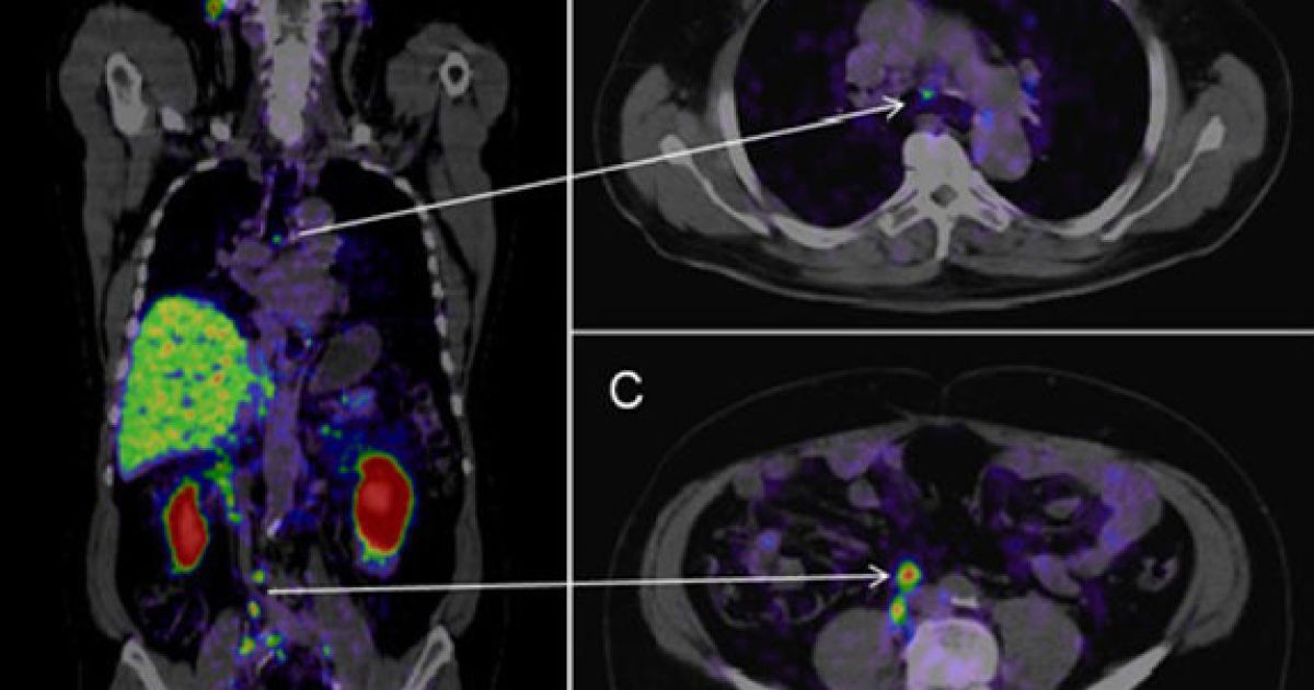PSMA Imaging Therapy and Targeted Therapy in Prostate Cancer | ZERO ...