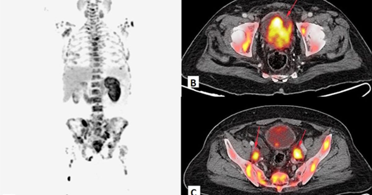 PSMA PET Imaging | ZERO Prostate Cancer